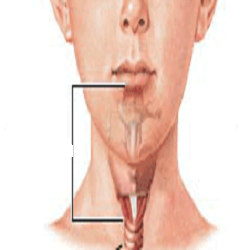 Acute Laryngotracheo Bronchitis-Infectious Croup - NursingNotes