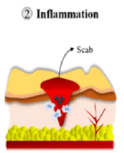 The Four Phases of Wound Healing: A Guide to the Wound Healing Process ...