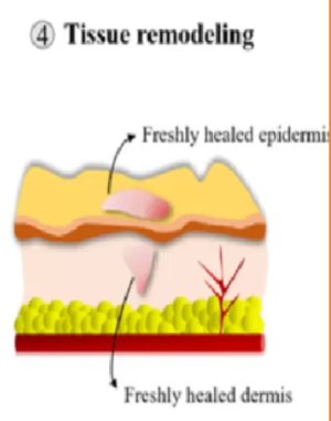 The Four Phases of Wound Healing: A Guide to the Wound Healing Process ...